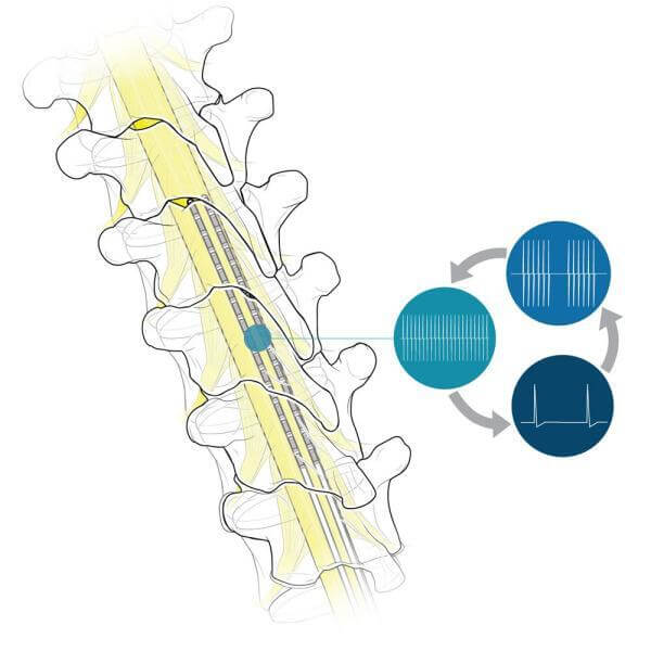 Frequently Asked Questions About Spinal Cord Stimulators for Low Back ...